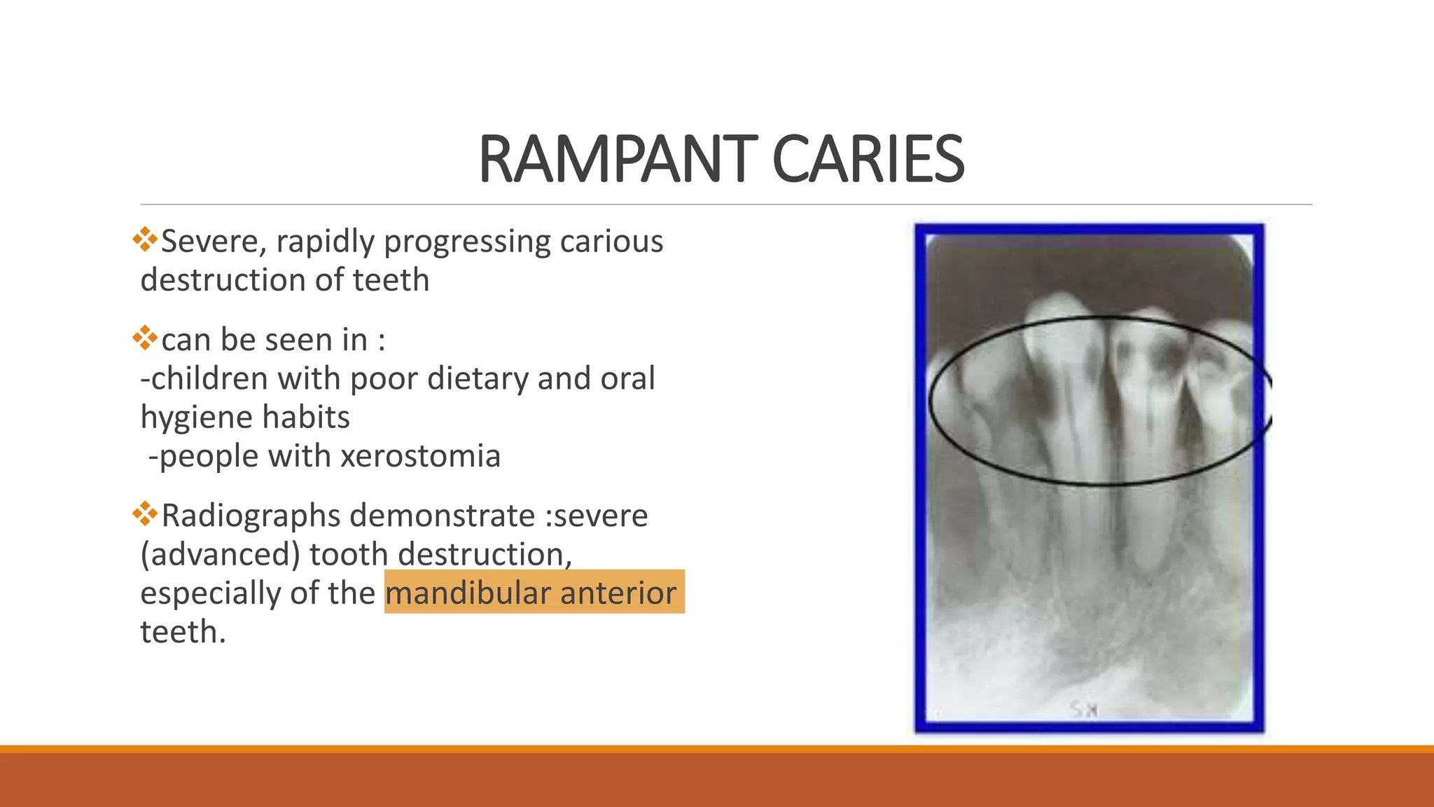 radiographic of interpretation of dental caries | PPTX