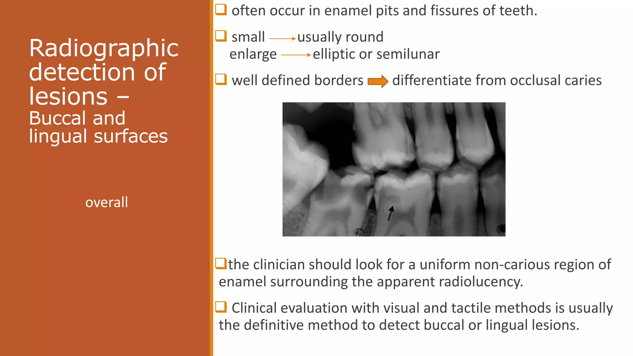 radiographic of interpretation of dental caries | PPTX