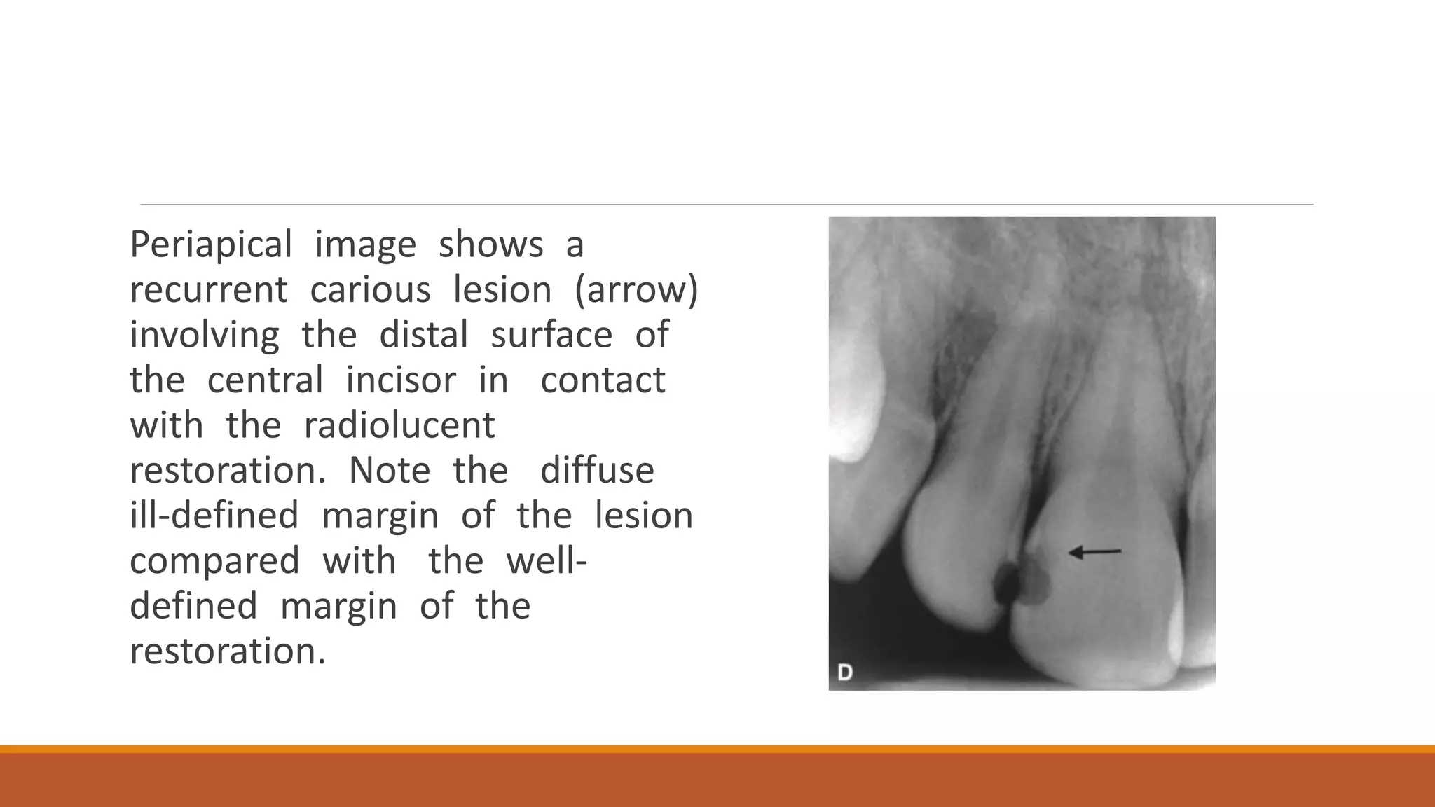 radiographic of interpretation of dental caries | PPTX