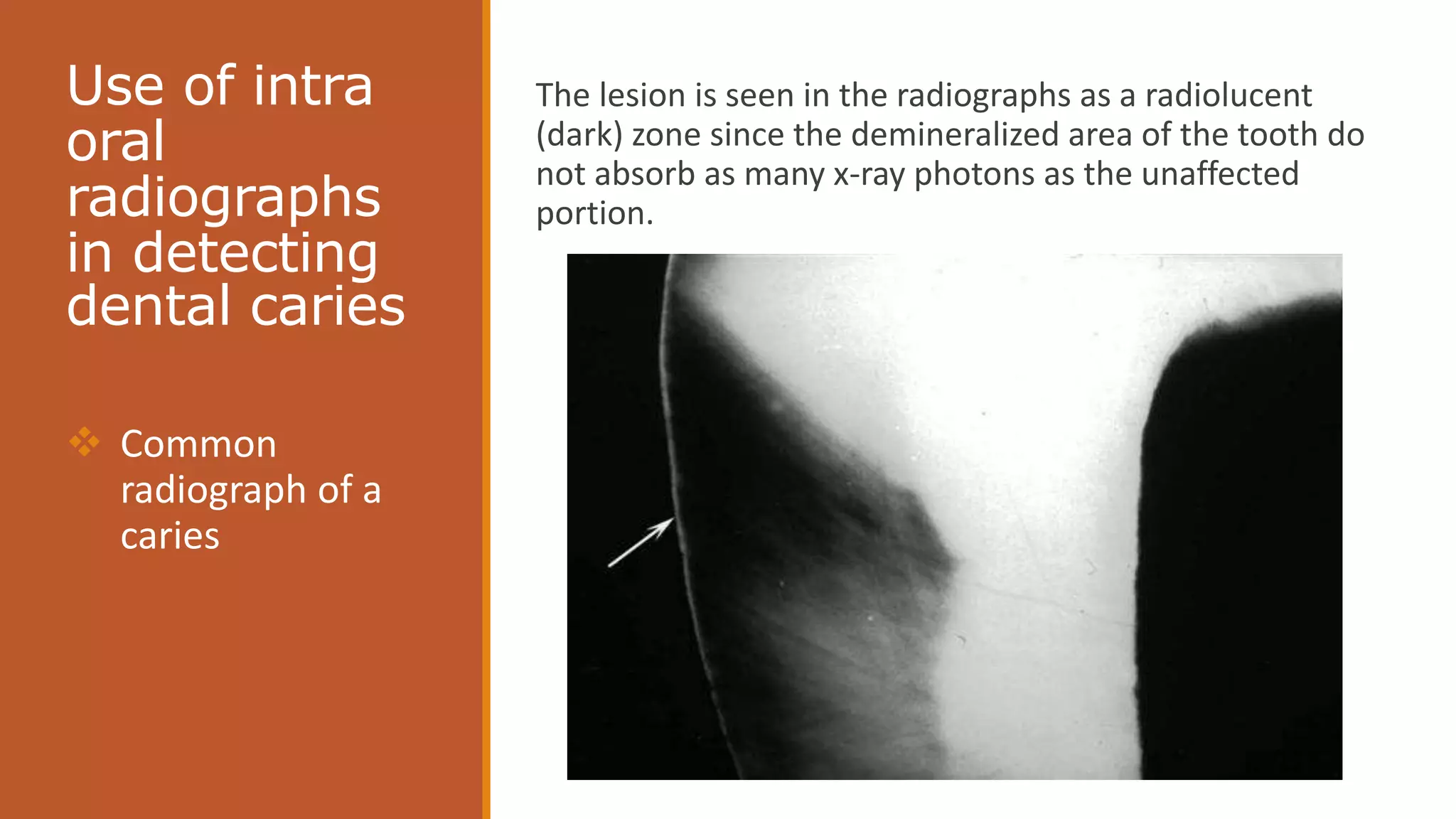 radiographic of interpretation of dental caries | PPTX