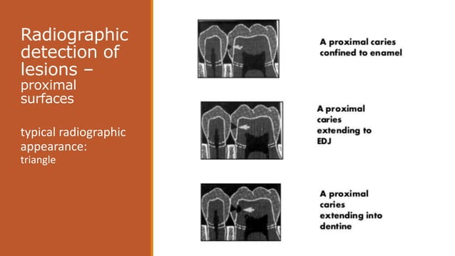 radiographic of interpretation of dental caries | PPTX