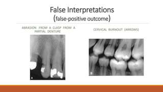 radiographic of interpretation of dental caries | PPTX