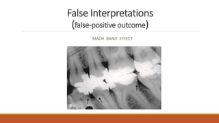 radiographic of interpretation of dental caries | PPTX