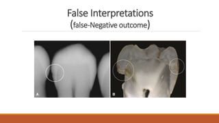 radiographic of interpretation of dental caries | PPTX