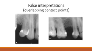 radiographic of interpretation of dental caries | PPTX