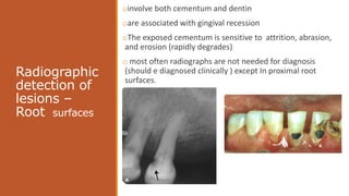 radiographic of interpretation of dental caries | PPTX