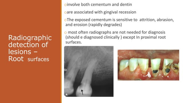 radiographic of interpretation of dental caries | PPTX