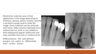 radiographic of interpretation of dental caries | PPTX