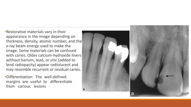 radiographic of interpretation of dental caries | PPTX