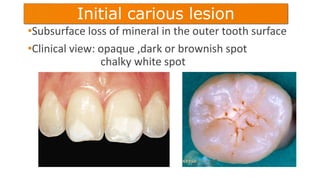 radiographic of interpretation of dental caries | PPTX