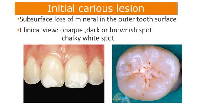 radiographic of interpretation of dental caries | PPTX