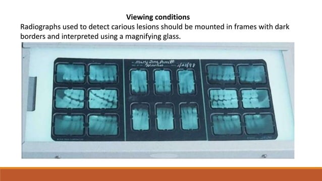 radiographic of interpretation of dental caries | PPTX