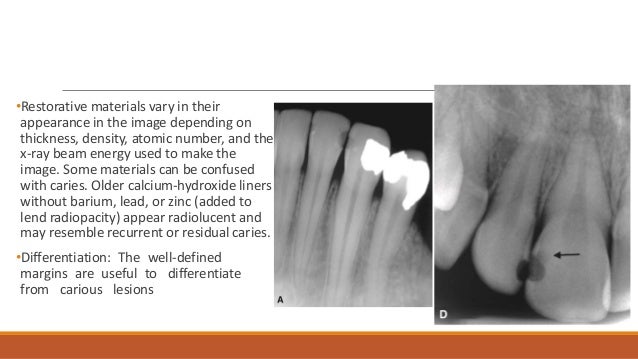 radiographic of interpretation of dental caries