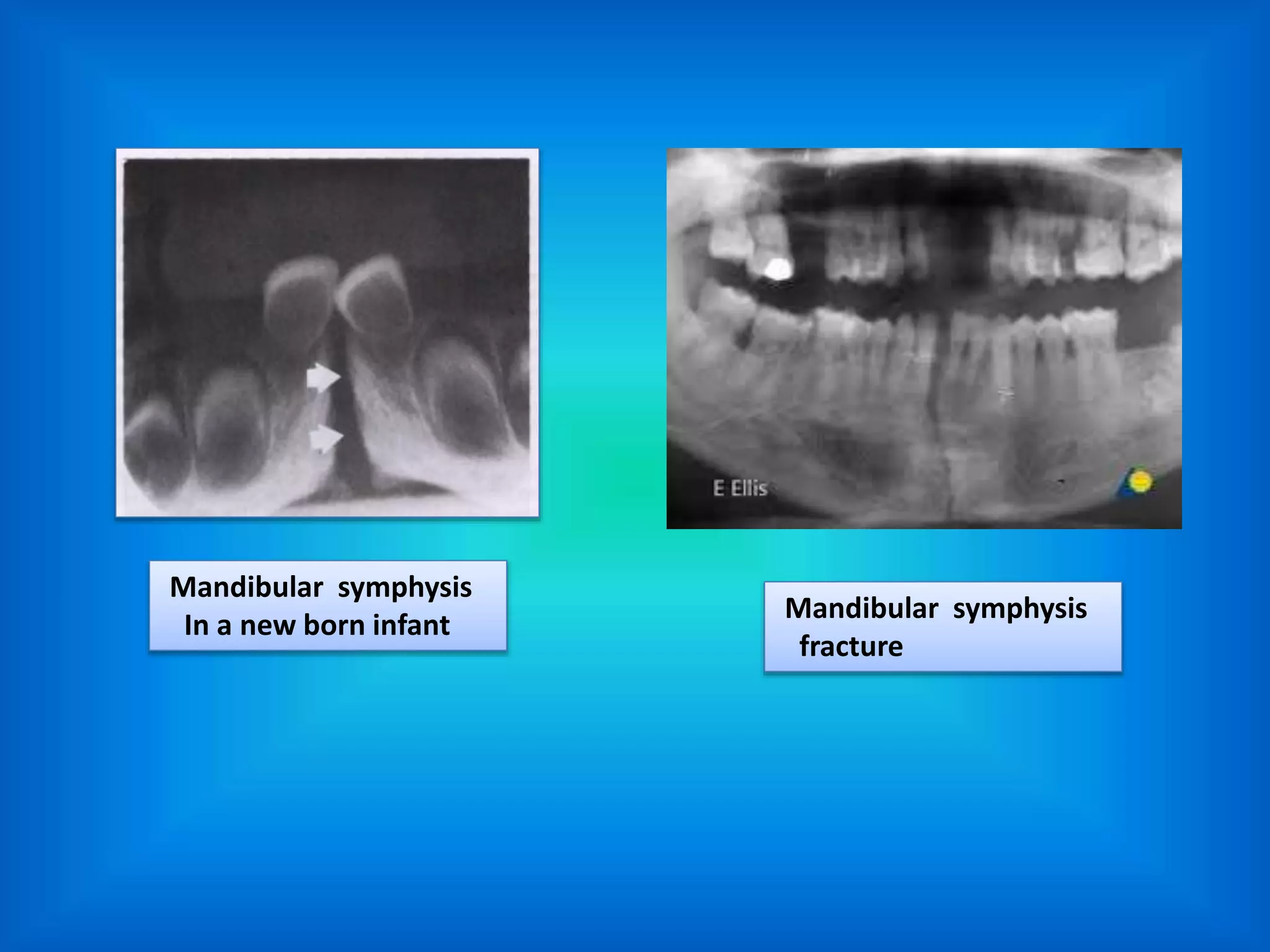 mandibular landmarks of radiograph | PPTX