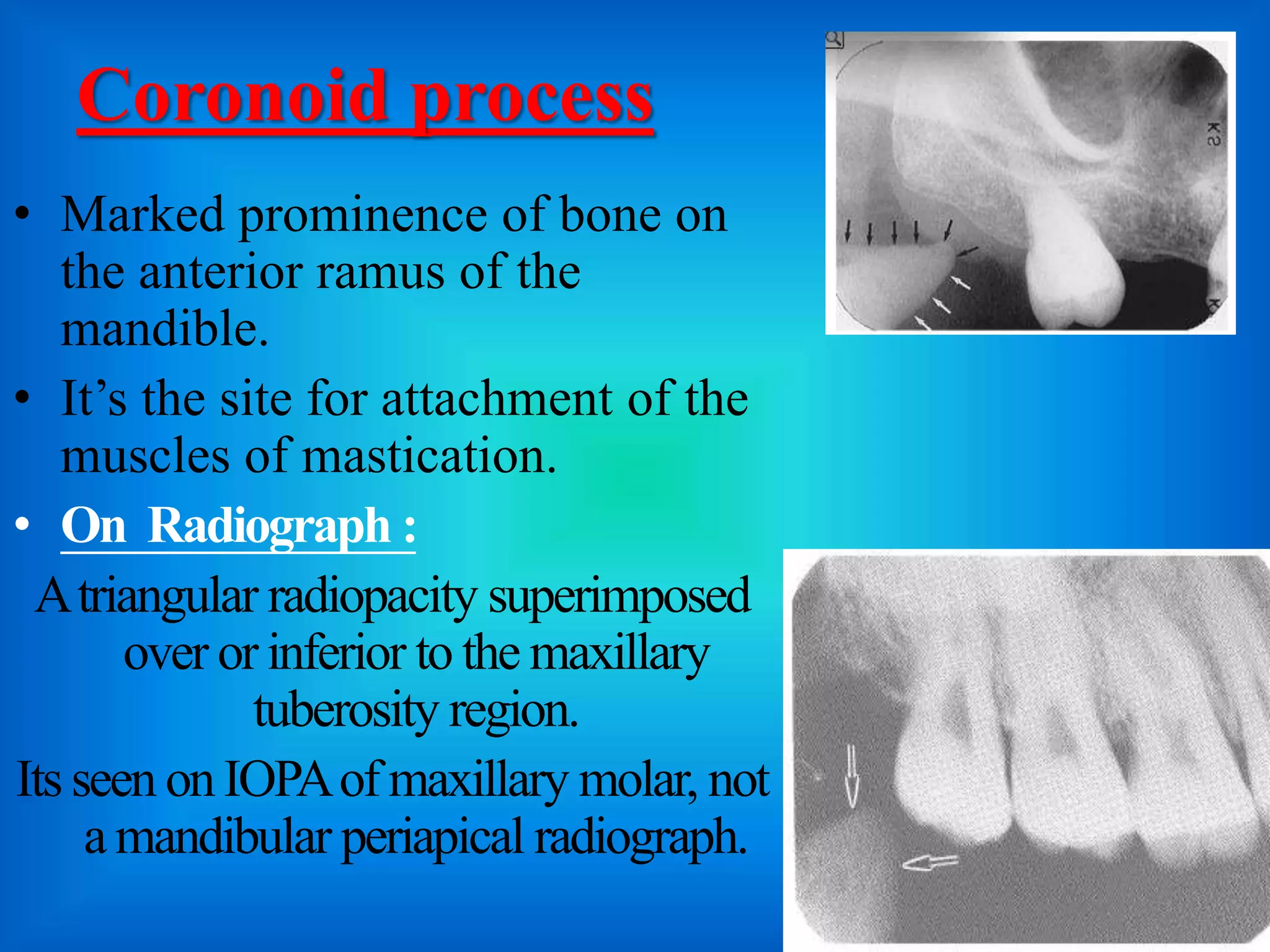 mandibular landmarks of radiograph | PPTX | Dental Health | Diseases ...