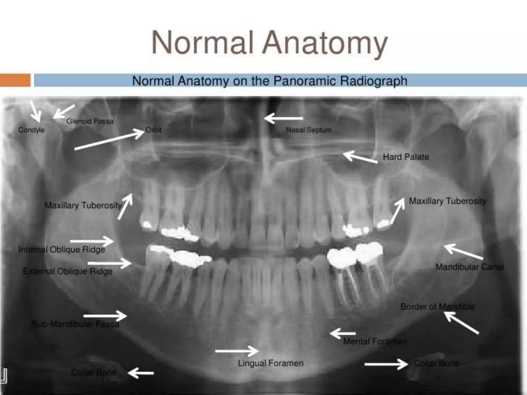 mandibular landmarks of radiograph | PPTX