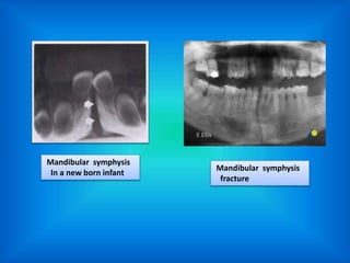 Genial Tubercles Xray