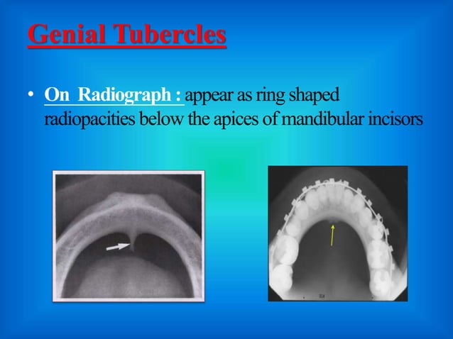 mandibular landmarks of radiograph | PPTX | Dental Health | Diseases ...