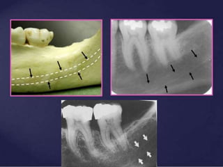 Submandibular Fossa Radiograph