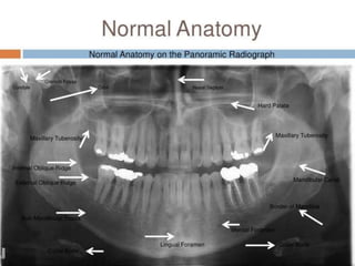 Oblique Ridge Mandible