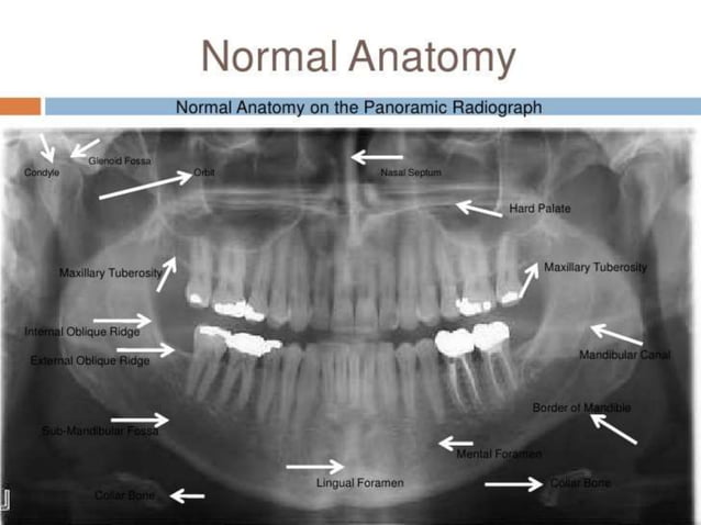 mandibular landmarks of radiograph
