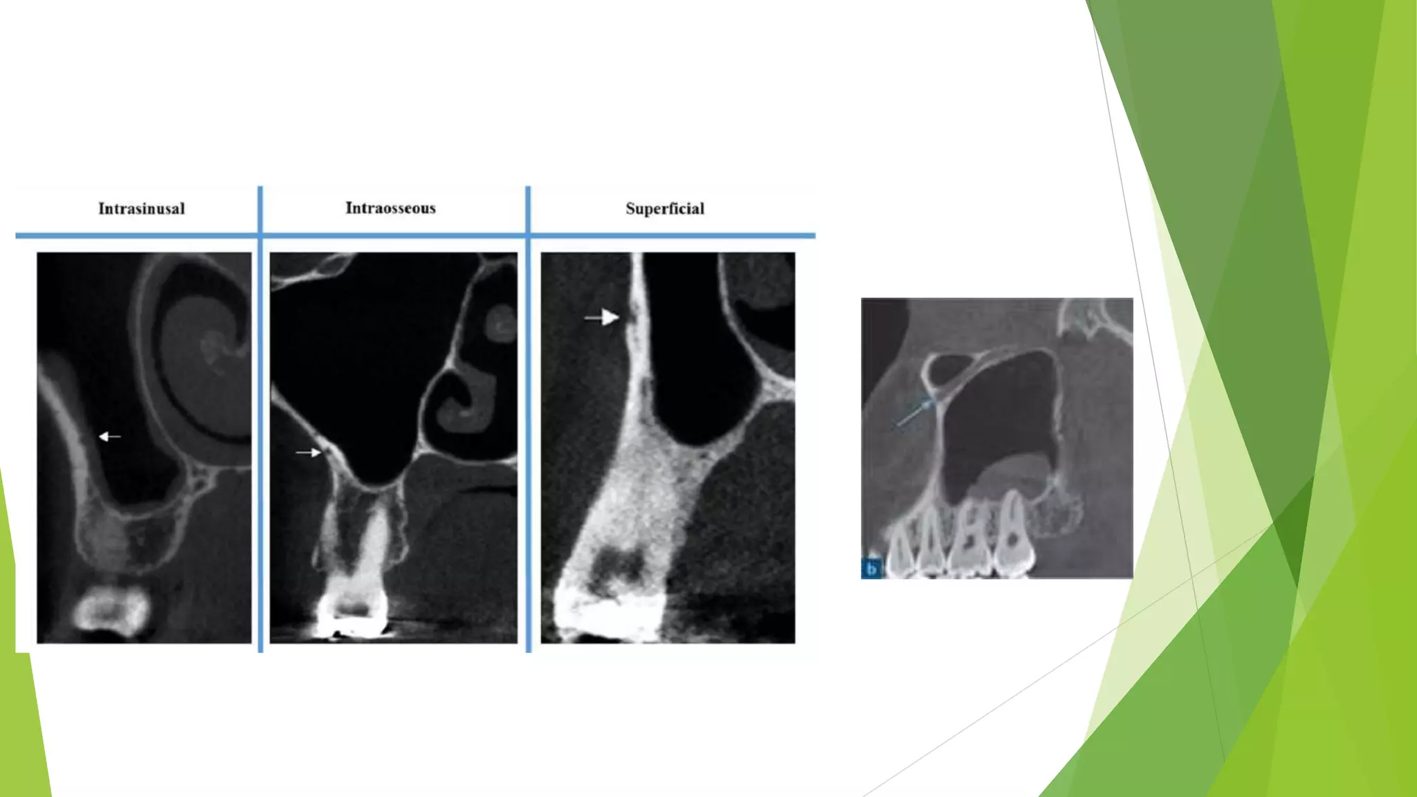 Anatomic variations in Maxillary Sinus detected by CBCT | PPTX