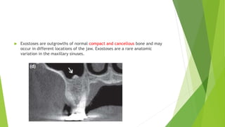 Anatomic variations in Maxillary Sinus detected by CBCT | PPTX
