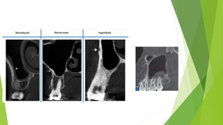 Anatomic variations in Maxillary Sinus detected by CBCT