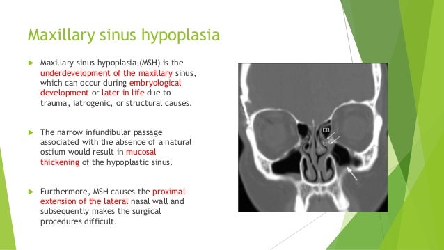 Anatomic variations in Maxillary Sinus detected by CBCT