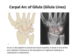 Radio-anatomy and Radio-pathology of hand and wrist.pdf