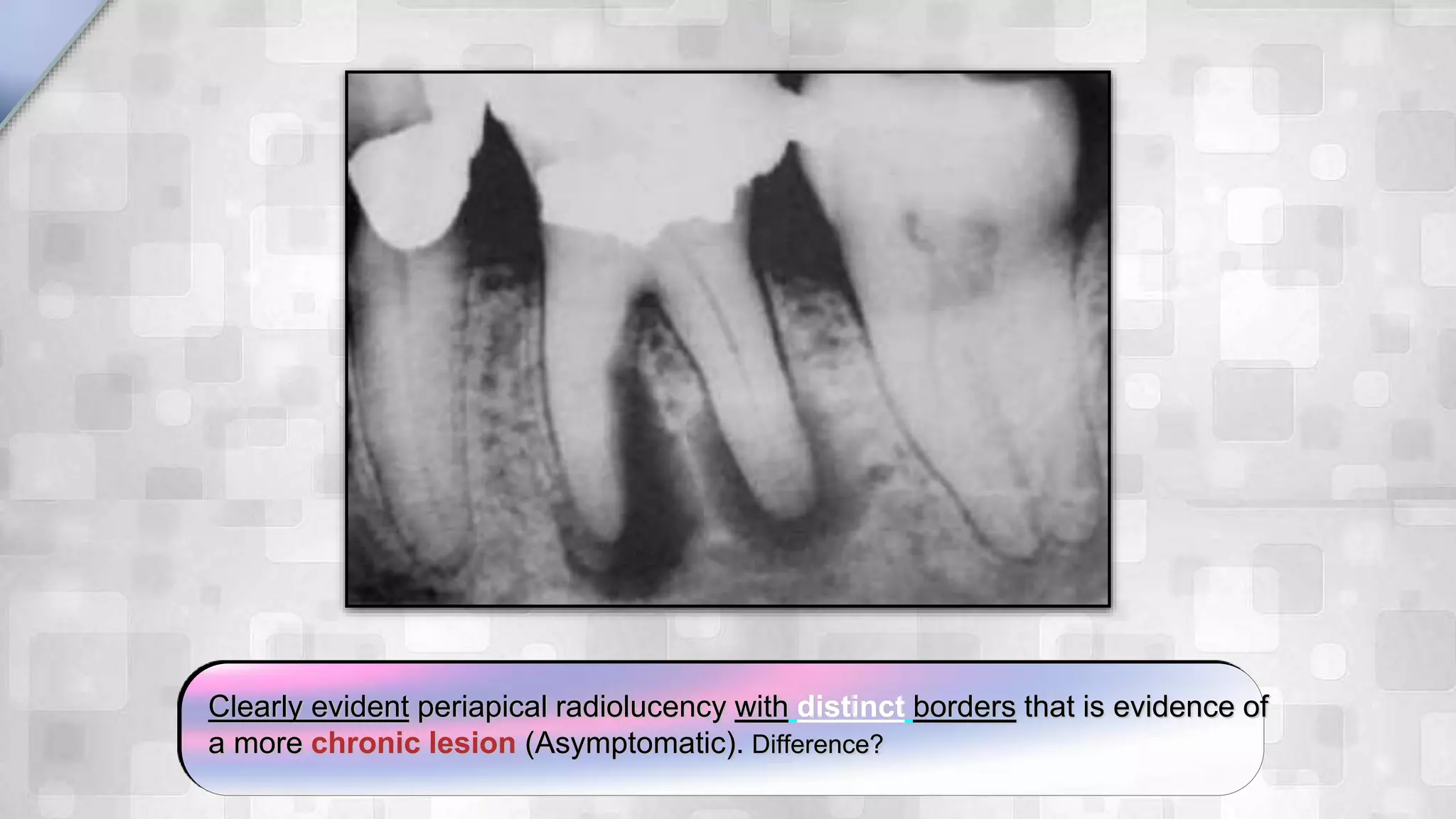 Radiographic findings of Endodontic lesions | PPSX