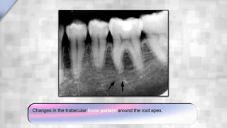Radiographic findings of Endodontic lesions | PPSX