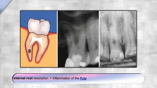 Radiographic findings of Endodontic lesions | PPSX | Dental Health ...