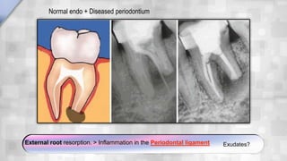 Radiographic findings of Endodontic lesions | PPSX | Dental Health ...