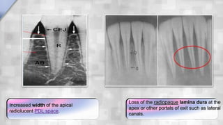 Radiographic findings of Endodontic lesions | PPSX | Dental Health ...