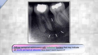 Radiographic findings of Endodontic lesions | PPSX | Dental Health ...