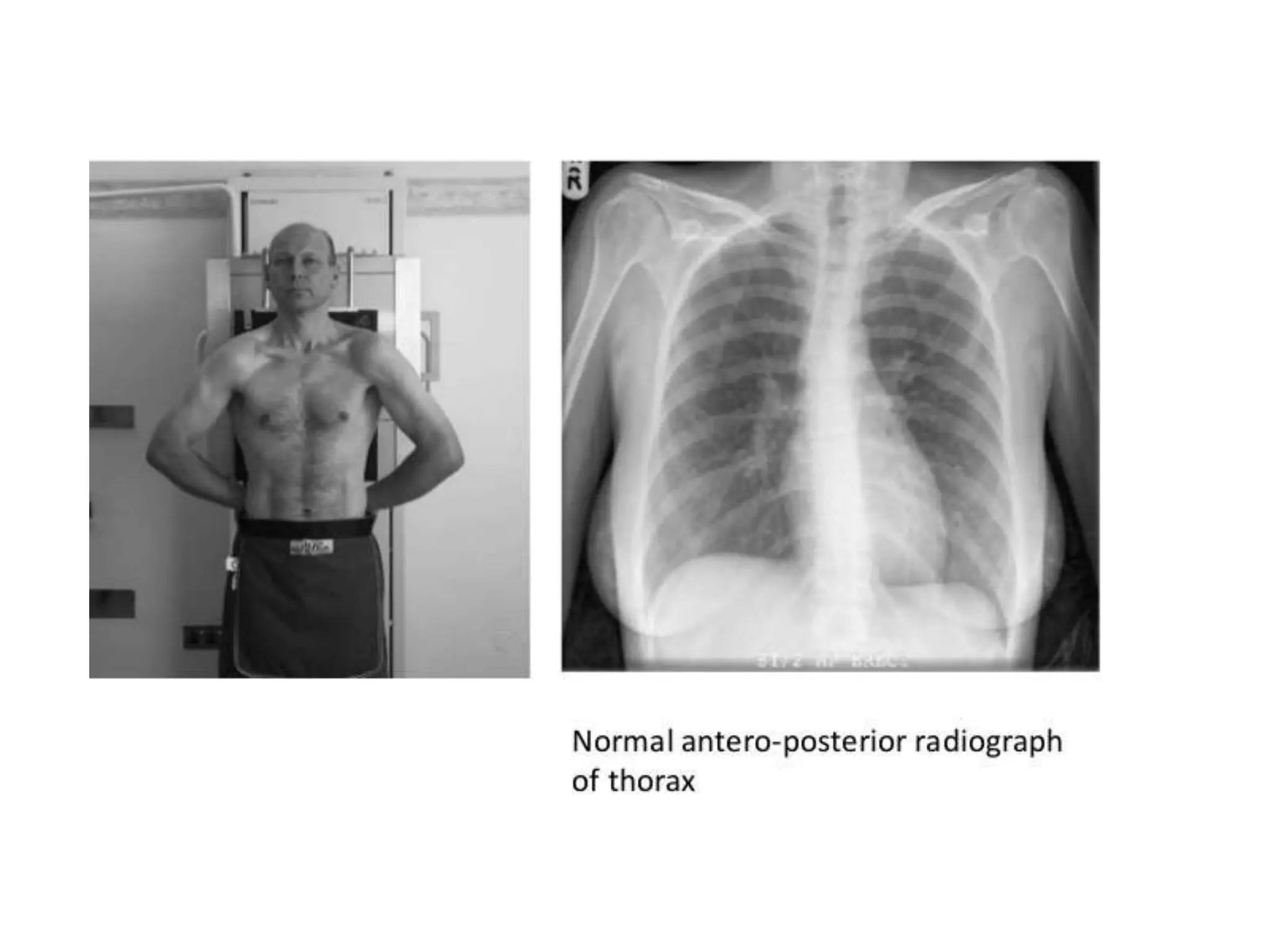 basics of chest xray | PPTX