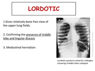 basics of chest xray | PPTX