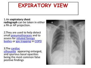 basics of chest xray | PPT