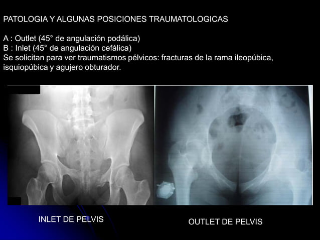 Radioanatomia de pelvis osea | PDF