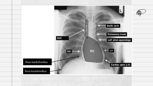 Radioanatomi Thorax_Andhina Shaffa A_4151211482.pptx