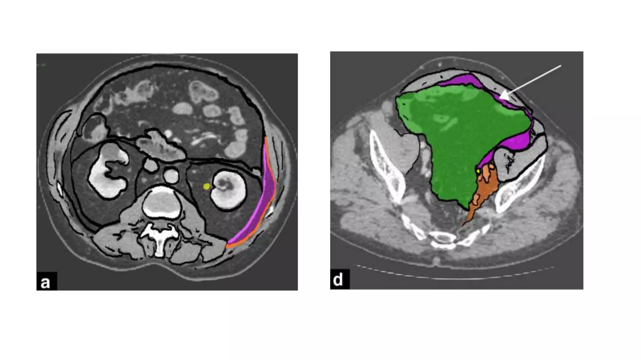 Radioanatomy of retroperitoneal space | PPTX
