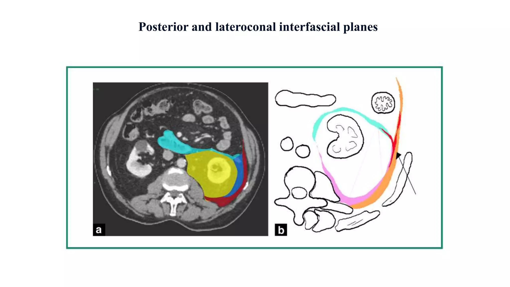 Radioanatomy of retroperitoneal space | PPTX
