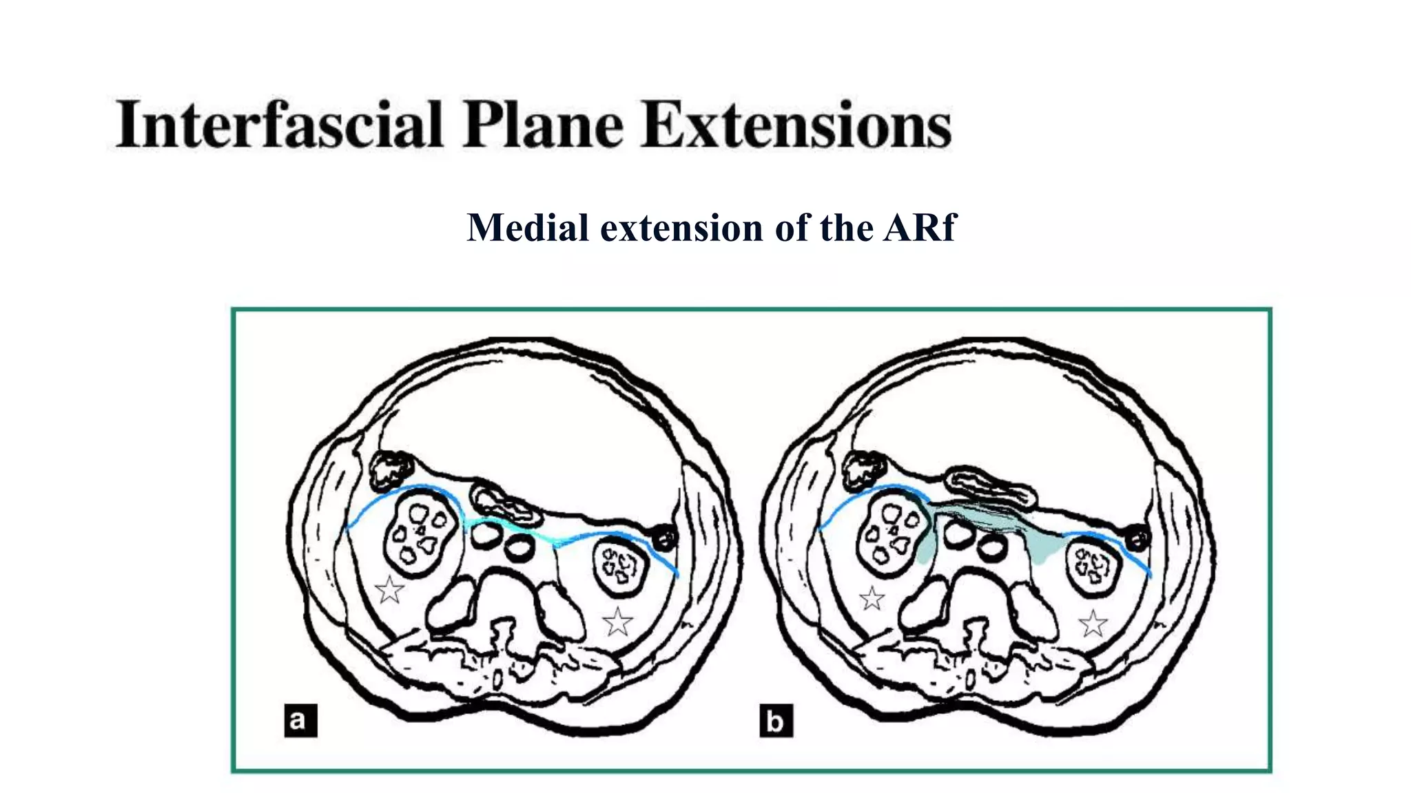 Radioanatomy of retroperitoneal space | PPTX