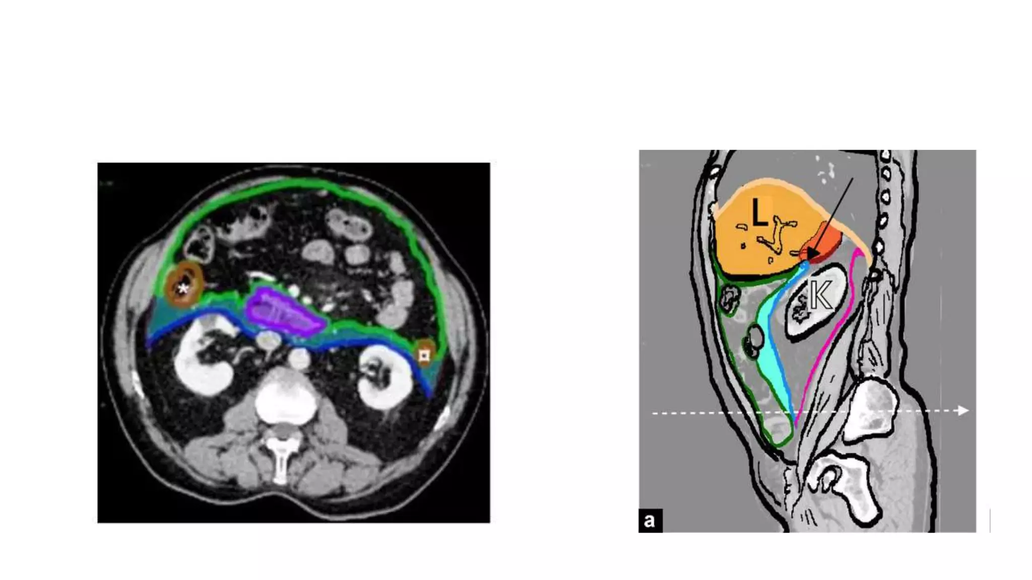 Radioanatomy of retroperitoneal space | PPTX | Design | Fine Art