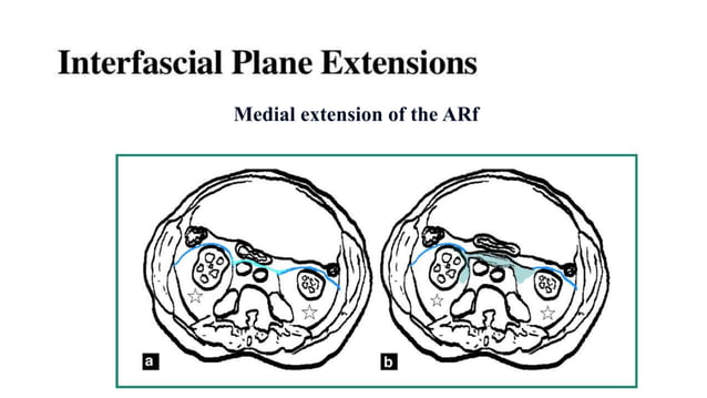 Radioanatomy of retroperitoneal space | PPTX | Design | Fine Art