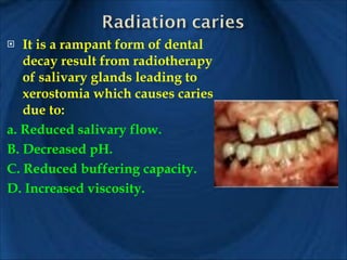 Radiation Caries
