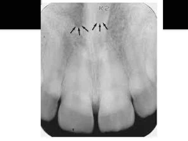 Radio dental anatomy 6,7 ppt teaching how radio anatomy worksin | PPTX