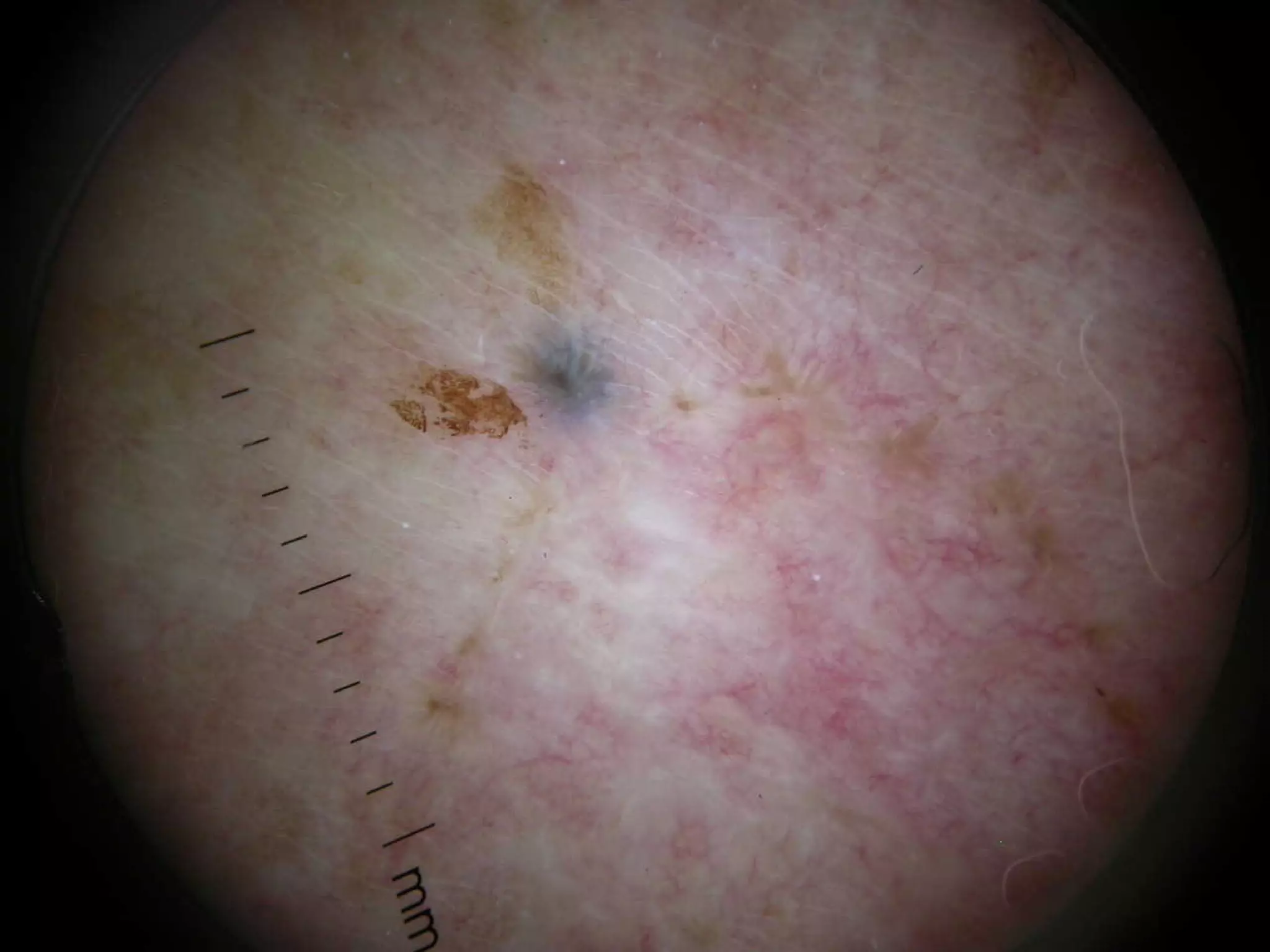 annular lesion on the breast | PPT