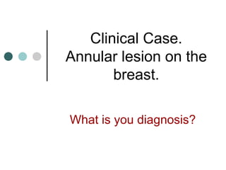 annular lesion on the breast | PPT